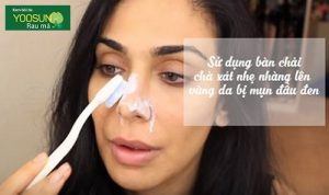 Nổi mụn ở mũi là bệnh gì? Nguyên nhân và cách trị mụn trên mũi