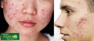 Mọc MỤN Ở MÁ là bị gì? Nguyên nhân và cách trị mụn trên má