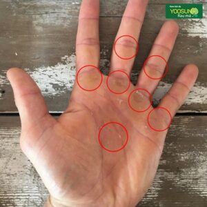 Vết chai tay làm sao hết? Nguyên nhân & cách làm hết vết chai tay